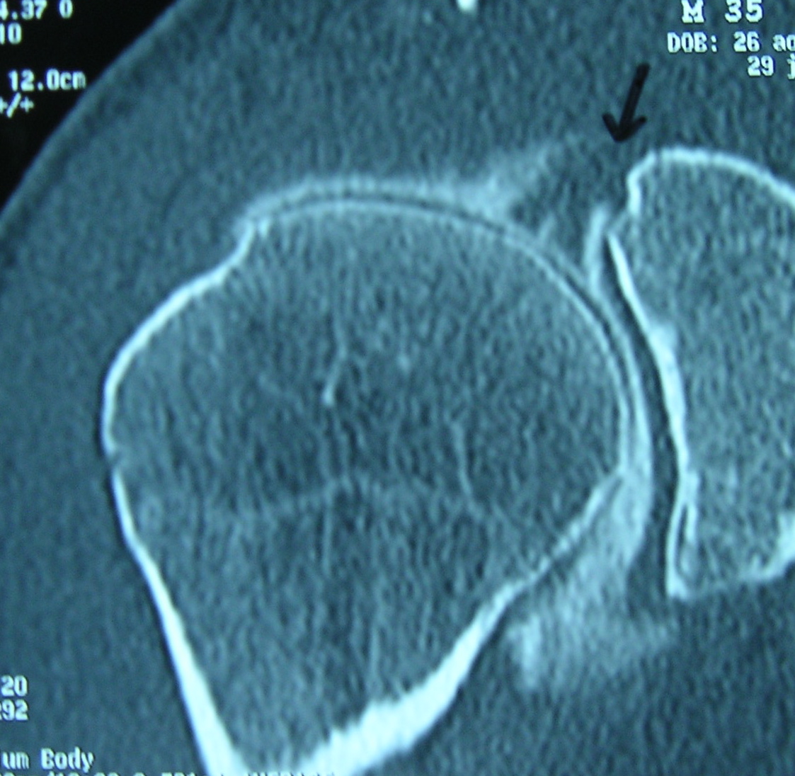 Luxation de l'épaule traitée par le Docteur Christophe CHAROUSSET à Paris