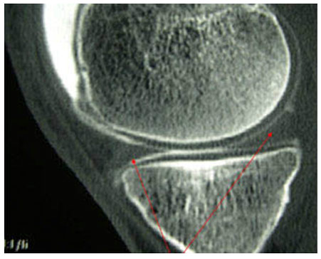 Opération du ménisque lésé