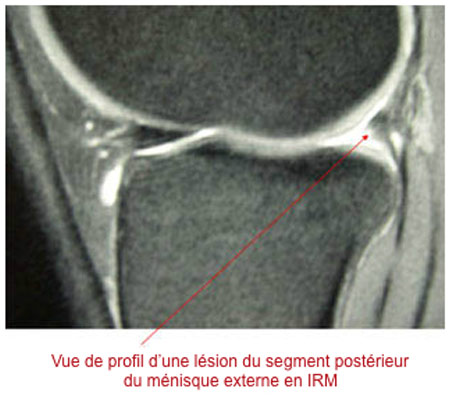 Opération du ménisque lésé